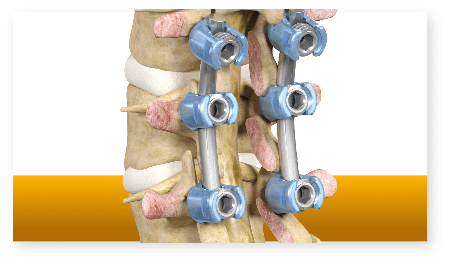 Laminectomy Without Fusion