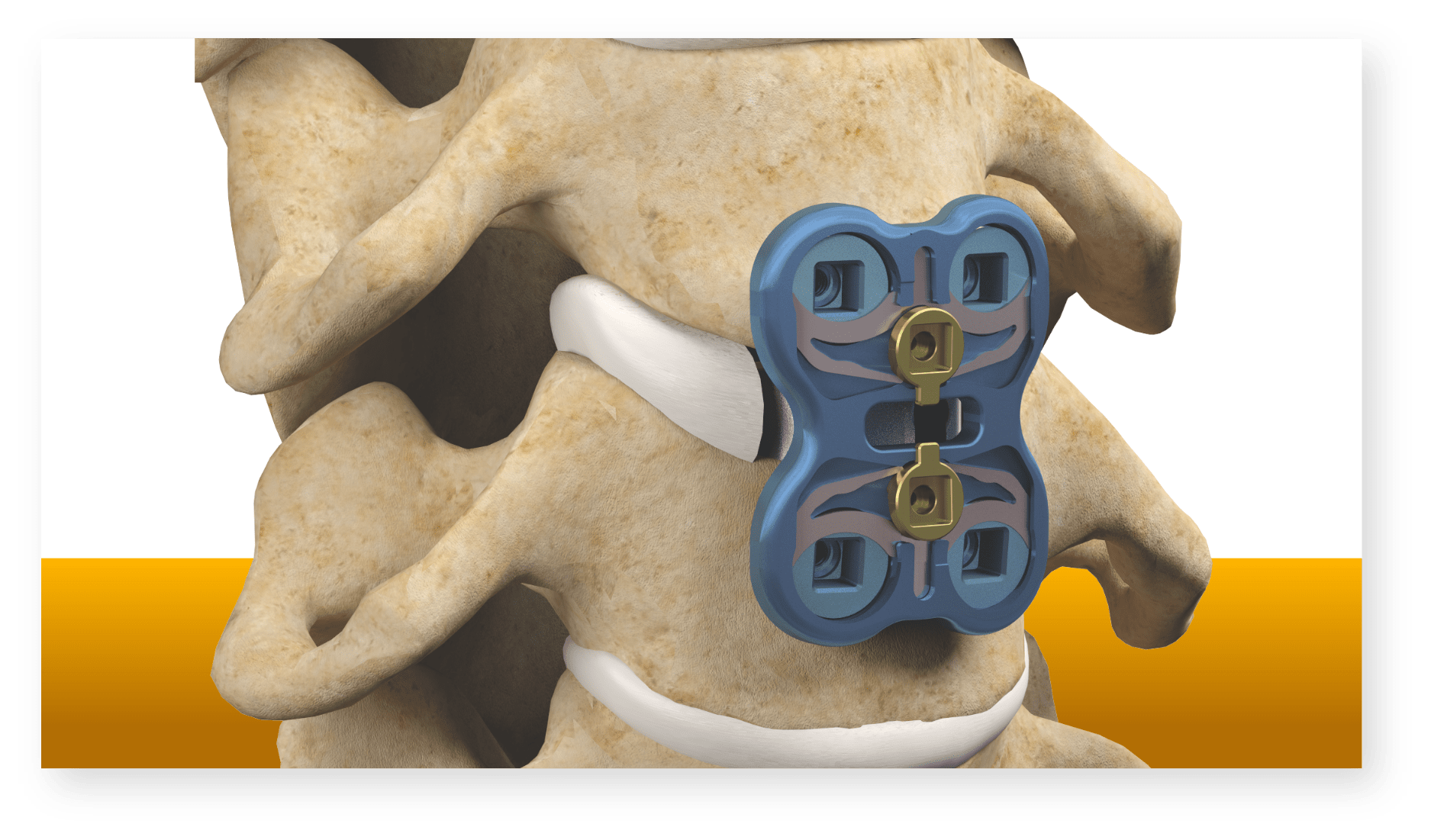 Cervical Foraminal Stenosis Surgery Spine health 41 OFF Cervical Foraminal Stenosis Surgery Spine health 41 OFF