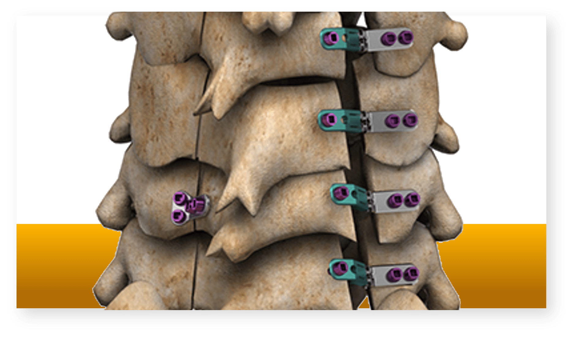 Cervical Laminoplasty Cervical Laminoplasty