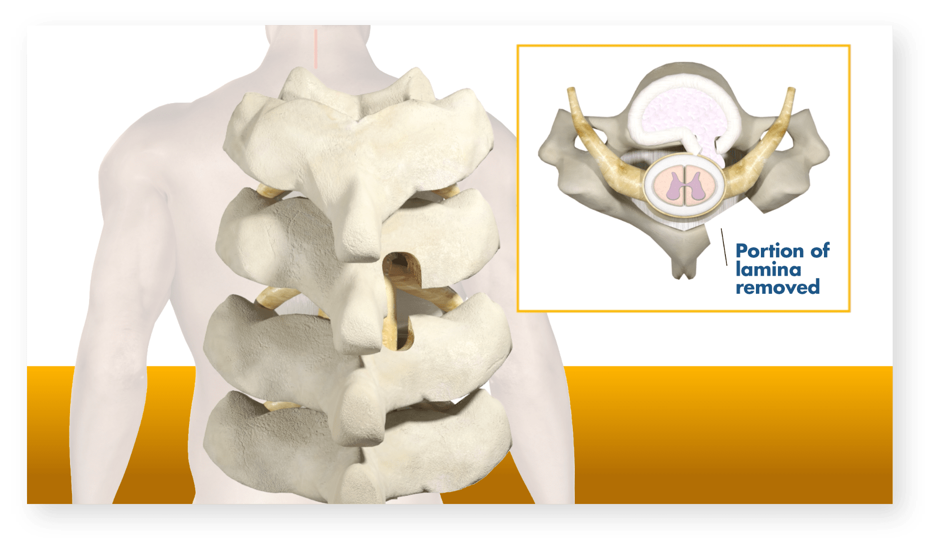 Cervical Laminectomy Cervical Laminectomy